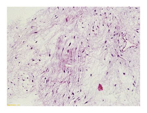On Histological Examination Abundant Myxoid Matrix With Few Cells Is