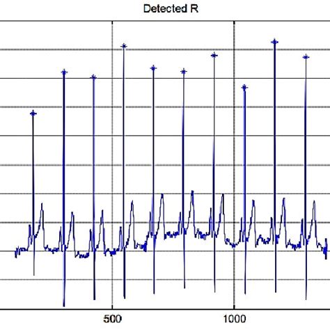 Detected R Peak In Ecg Signal Before Processing The Signal It Is Download Scientific Diagram