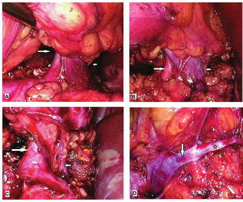 Renal Hilar Dissection Demonstrating A Delineation Of Both Superior