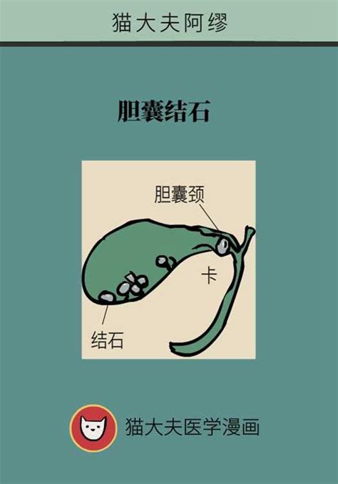 膽結石患者能吃肥肉嗎？關於膽結石你需要知道這些 每日頭條