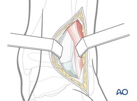 Posterolateral Approach To The Pediatric Distal Tibia