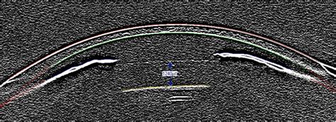 Oversized Implantable Collamer Lens In This Case A Hypervault Of