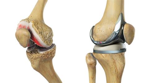 A Total Knee Replacement Also Known As A Total Knee Arthroplasty Tka