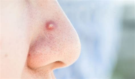 What Causes Red Spots On The Nose And Treatment