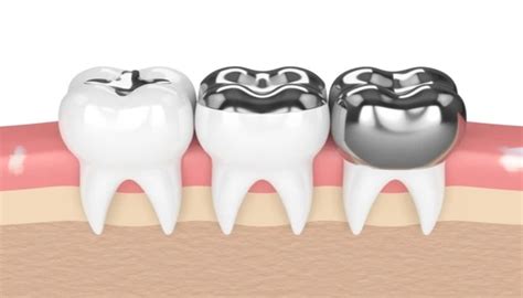 Silver Teeth Advantages And Disadvantages Dental Center Of Tysons Corner