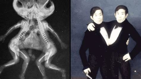 What Actually Happens If One Conjoined Twin Dies But The Other Continues Living