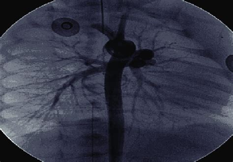 Stent Deployed In Pda Wire And Deflated Balloon Still In Pda Figure Download Scientific