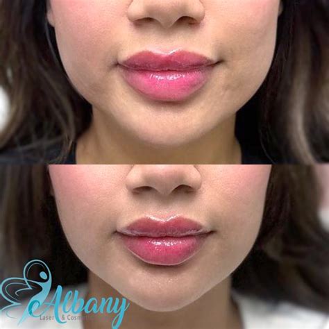 Masseter Botox Case No 1382 Albany Cosmetic And Laser Centre Edmonton
