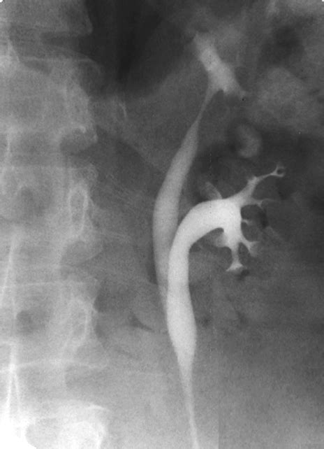 If Disease Congenital Partial Duplication The Common Vein
