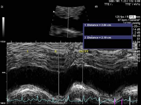 An Echo In Pulmonary Embolus Pe Intensive