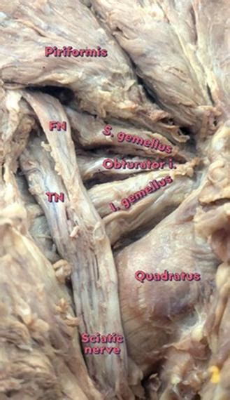 High Division Of The Sciatic Nerve Split By The Superior Gemellus
