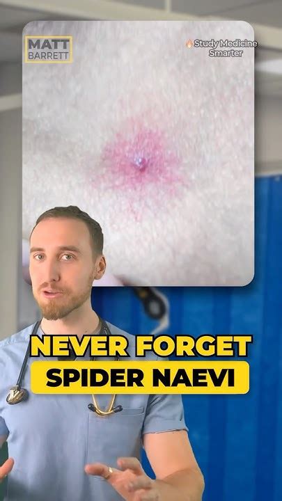 Spider Naevi Everything You Need To Know Youtube