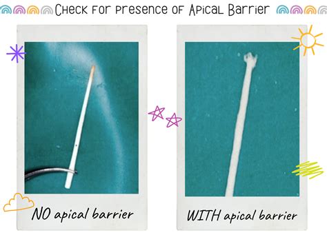 Apexification Procedure Pediatric Dentistry Workbook