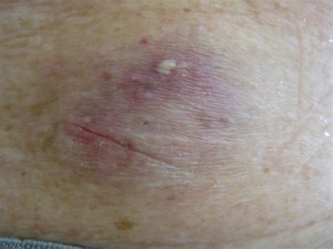 Staphylococcus Lugdunensis Case Report And Discussion Donoghue 2014 Australasian Journal