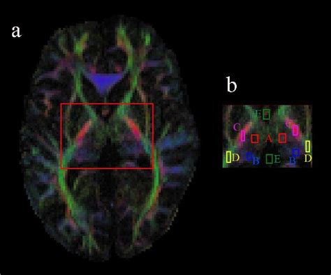 Figure 75 From Segmentation Of Diffusion Weighted Mri Using The Level Set Framework Semantic
