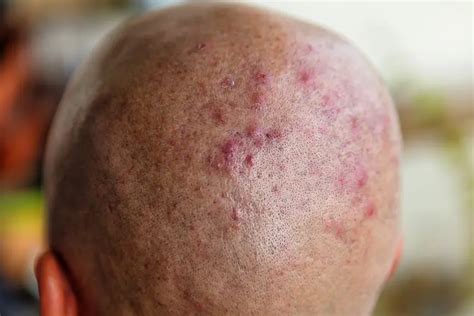 What To Know About Scalp Acne Head Acnes