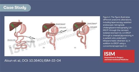 Innovations In Surgery And Interventional Medicine On Linkedin Laparoscopic Assisted Endoscopic