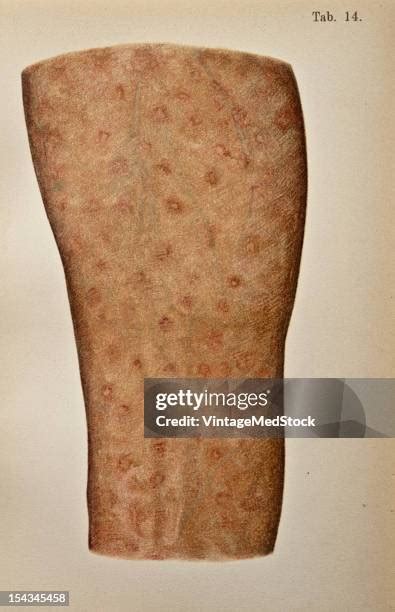 All Scalp Diseases Photos And Premium High Res Pictures Getty Images