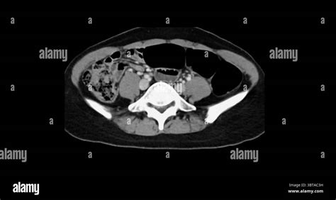 Contrast Enhanced Ct Whole Abdomen Study Revealing Normal Anatomical