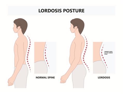 Que Es Lordosis Lumbar Rectificada Adalah
