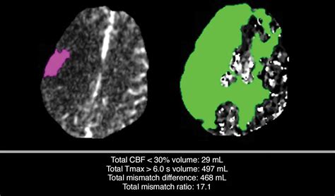 Perfusion Motion Artifact At Linda Rice Blog