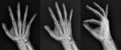 Anteroposterior View Of The Right Hand Middle Finger Mcp Joint Showing