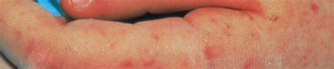 Meningococcemia Symptoms Causes Mediko Ph