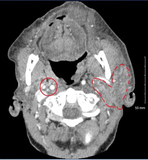 First Reported Case Of Deglutition Syncope With Underlying Suppurative
