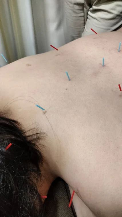 肩・膝関節の痛みと鍼灸治療｜高松市ありす鍼灸整骨院｜高松市十川東町の鍼灸整骨院｜肩こり・腰痛・自律神経ならありす鍼灸整骨院（ありす整体院）｜香川県高松市十川東町83−1