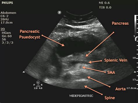 Pancreatic Pseudocyst Ultrasound