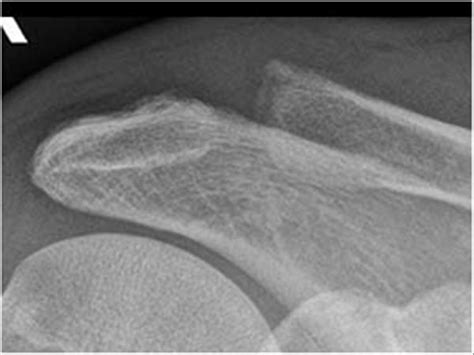 Musculoskeletal Joints And Tendons 61 Shoulder Case 6123