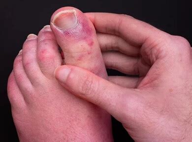 Why Are My Feet Red Symptoms Causes And Treatment For Red Feet
