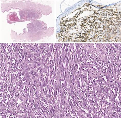 A Case Report Of Post Radiotherapy C Myc Positive Angiosarcoma Of The