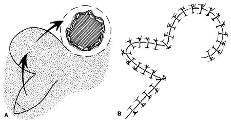 Volume 5 Chapter 88 Flaps Grafts And Alloplastic Materials In Lid Reconstruction And Repair