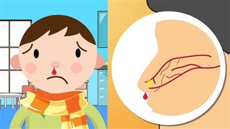 Ep1 ทำไมเลือดกำเดาไหล Youtube