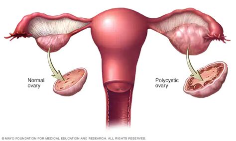 Github Donasam Pcos Detection