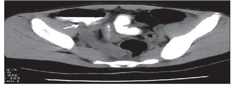 Ct Scan Shows An Abnormal Appendix
