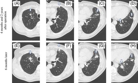 Computed Tomography Findings Showing Multiple Nodules In The Right Download Scientific Diagram