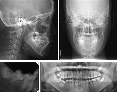 Efficient Usage Of Implant Anchorage To Treat Overerupted Maxillary