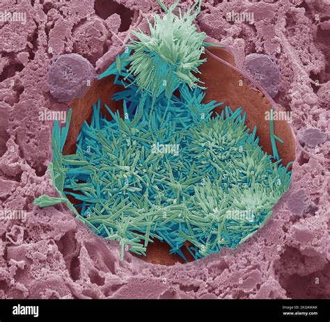 Coloured Scanning Electron Micrograph Sem Of Cholesterol Crystals Cyan Within A Lipid