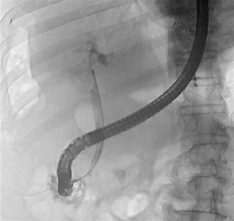 Cholangiogram Demonstrating Filling Defects At The Common Hepatic Duct Download Scientific