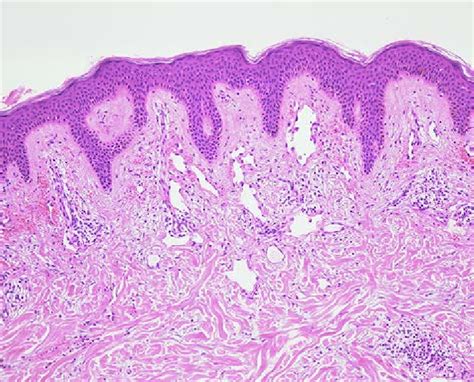 B Hobnail Hemangioma The Typical Hobnail Appearance Of Endothelial
