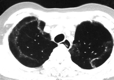 Ct Scan On Admission Also Revealed Subpleural Curvilinear Shadow Within