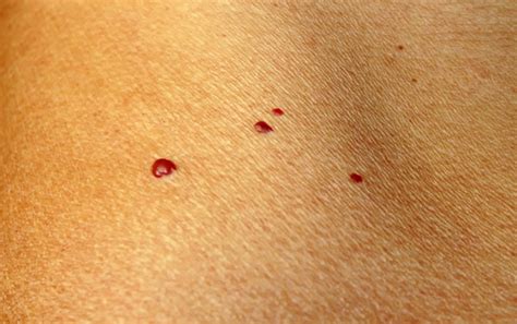 Does A Bleeding Spot Affect My Ablution Or Prayer Seekersguidance