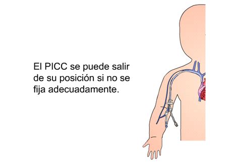 Catéter Central De Inserción Periférica Picc Pediatría