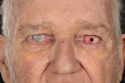 Patient After Tooth In Eye Surgery Stock Image C0494364 Science