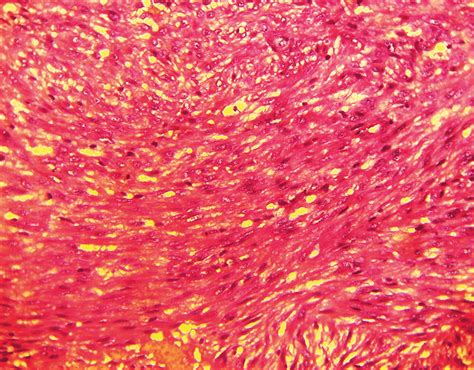Photomicrograph Showing Intersecting Fascicles Of Spindle Shaped Cells