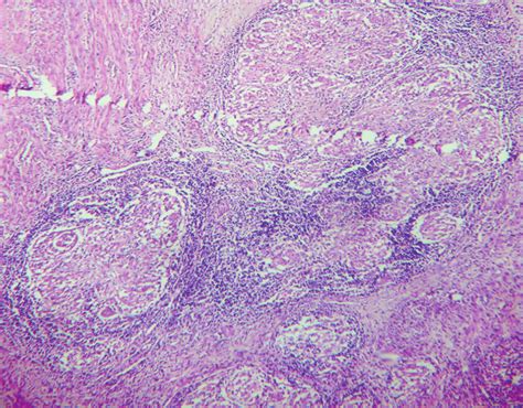 Caseating Epithelioid Cell Granulomas With Lymphocytic Cuffing Download Scientific Diagram