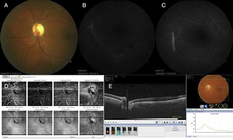 Arteria Hialoidea Persistente Archivos De La Sociedad Española De
