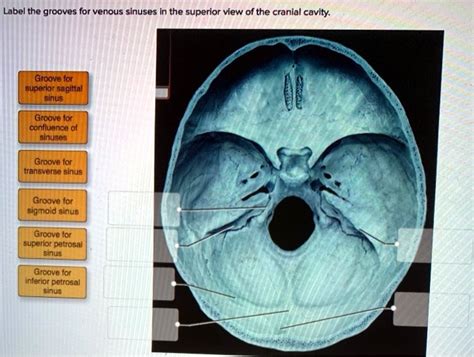 Confluence Of Sinuses Skull